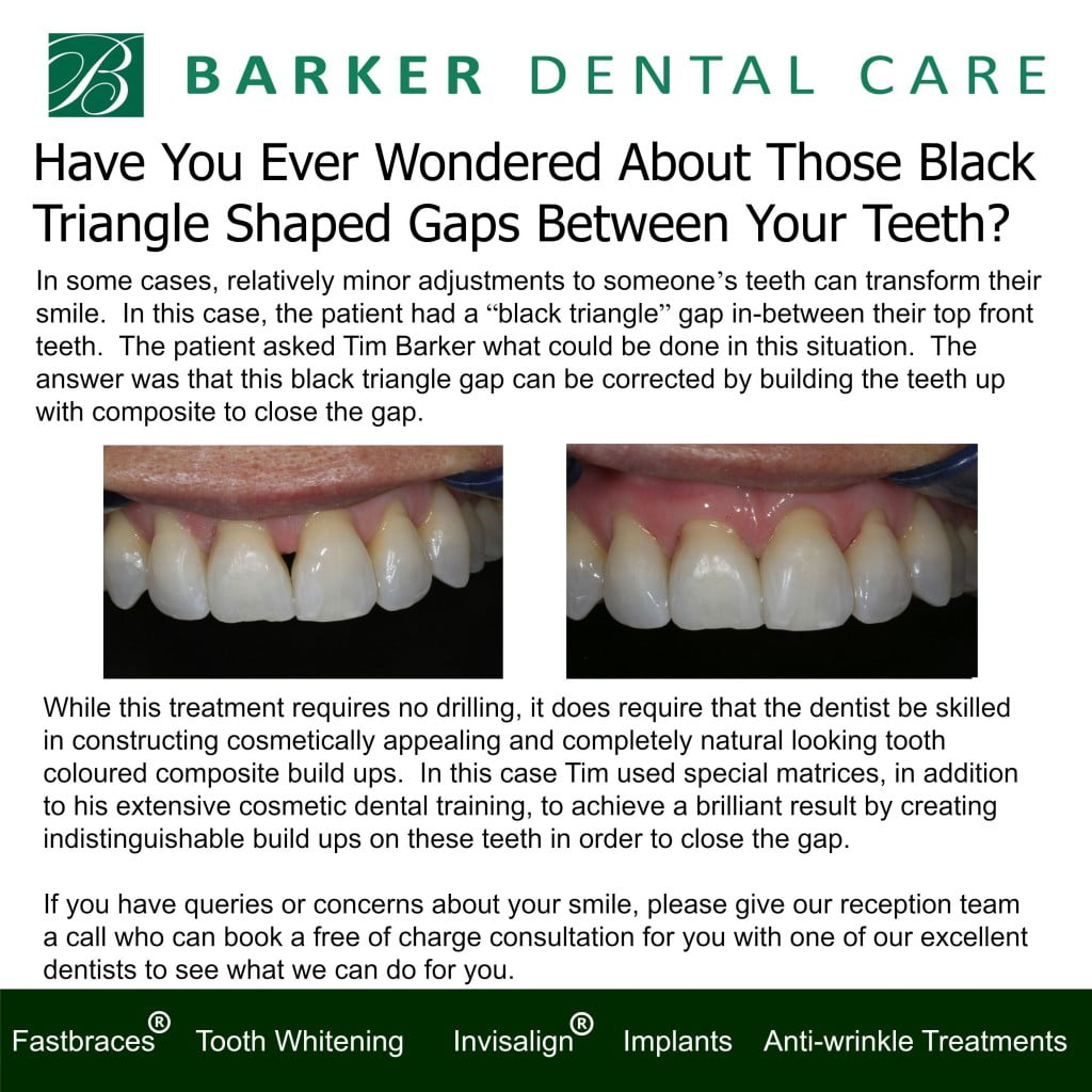 Black Triangle Gaps - Barker Dental Care