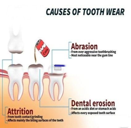 Do You Have Tooth Wear? Barker Dental Care Southampton