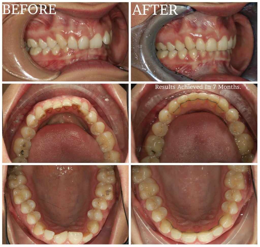 Do You Want Straight Teeth? Fastbraces® Could Be The Answer
